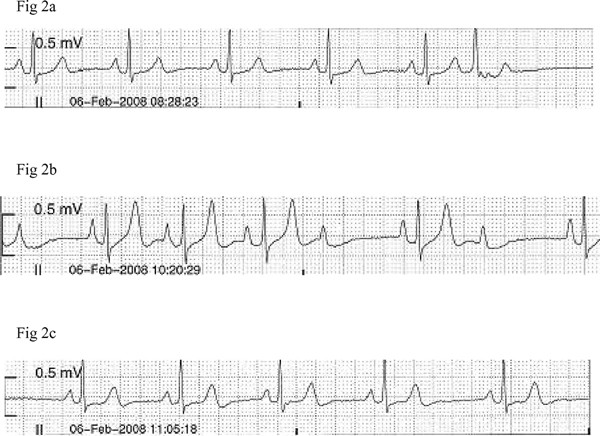 Hypertensive crisis-induced electrocardiographic changes: a case series ...