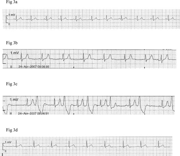 Hypertensive crisis-induced electrocardiographic changes: a case series ...