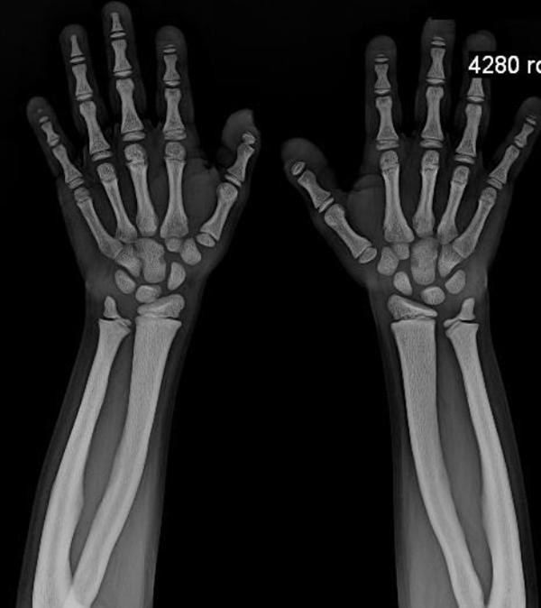 Pycnodysostosis with unusual findings: a case report | Cases Journal ...