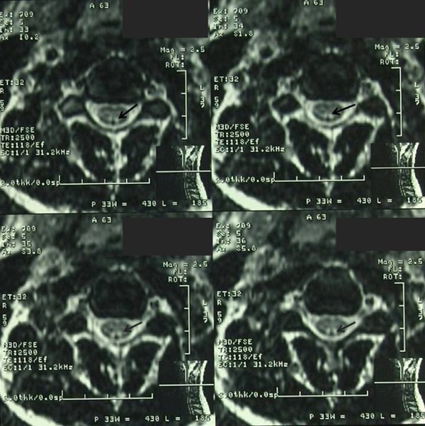 Sub-acute combined degeneration with an initially normal level of ...