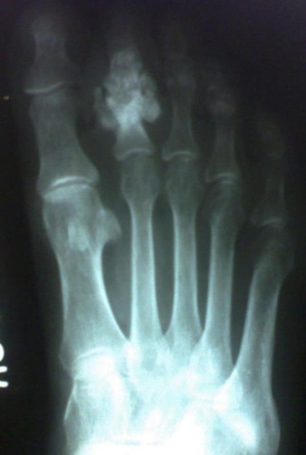 Trans-articular chondrosarcoma grade 2 of proximal phalanx resulting in ...