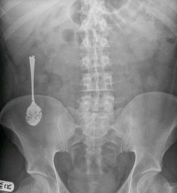 Surgical removal of a tea spoon from the ascending colon, ten years ...