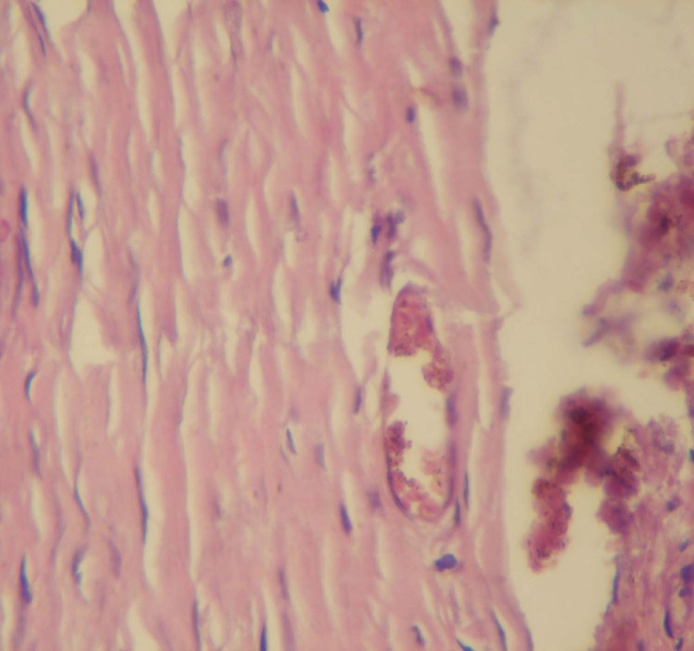 Sublingual epidermoid cyst: a case report | Cases Journal | Full Text