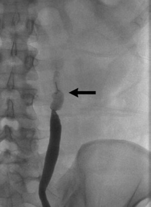Impaktiertes Konkrement des linken proximalen Ureters mit angrenzender ...