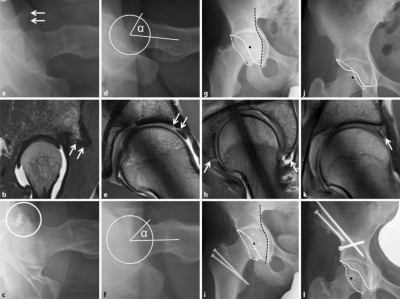 Coxarthrose | Impingement der Hüfte | springermedizin.de