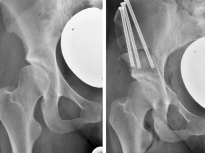 Coxarthrose | Hüftschmerz: Ursachen, Differenzialdiagnosen und Therapie ...