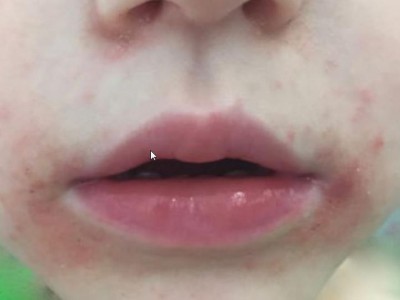 Aphthen | Orale und periorale Dermatosen richtig diagnostizieren ...