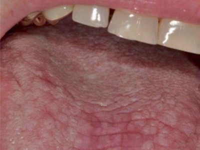 Lichen ruber | Oraler Lichen planus — eine interdisziplinäre ...
