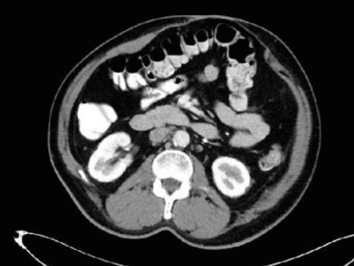 Narbenhernie | Narbenhernien: minimalinvasive Operationsverfahren ...