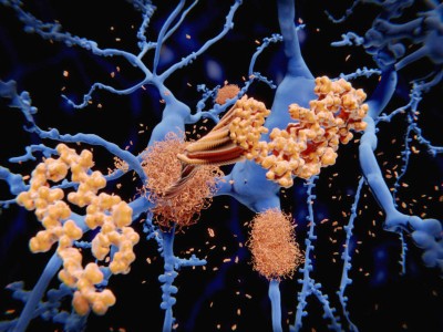 Morbus Alzheimer | Lecanemab jetzt in Deutschland verfügbar ...
