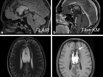 Lipom | Pathologien des Corpus callosum in der Bildgebung ...
