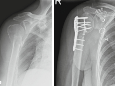 Strecksehnen | Tenolyse von Streck- und Beugesehnen an der Hand ...