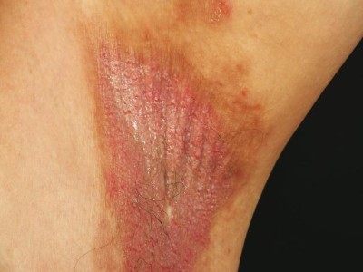 Morbus Grover | Vielfältige Klinik, differenzierte Therapie ...