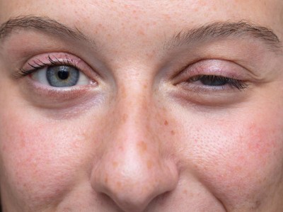 Thymome | Update Myasthenia gravis | springermedizin.de