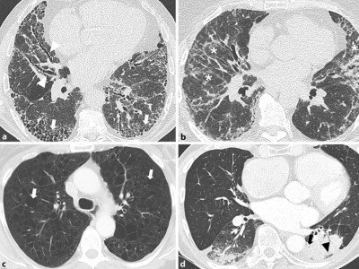 Strecksehnen | Tenolyse von Streck- und Beugesehnen an der Hand ...