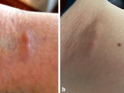 Weichteiltumoren | Plexiformer fibrohistiozytärer Tumor ...