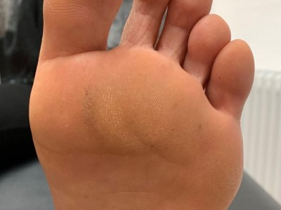 Orthopädische Erkrankungen in der Hausarztpraxis | Spreizfuß: Typisch ...