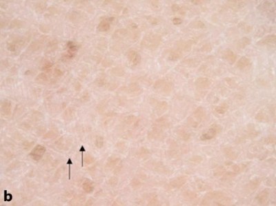 Dermatologische Diagnostik | Dermatoskopie von Genodermatosen ...