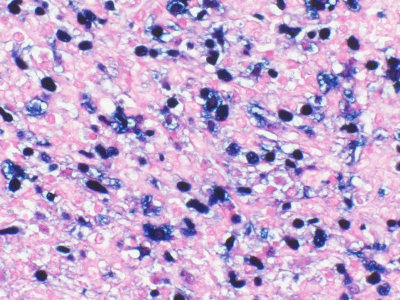 Lymphoma | Primary hepatic Epstein–Barr virus-positive diffuse large B-cell lymphoma associated ...