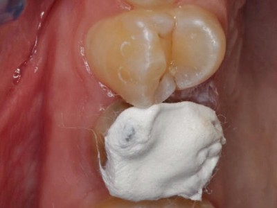 Prophylaxe in der Kinderzahnmedizin | CCP-ACP-Paste zur Behandlung ...