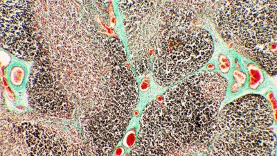 Thymektomie | Wie wichtig ist die Thymusdrüse? | springermedizin.de