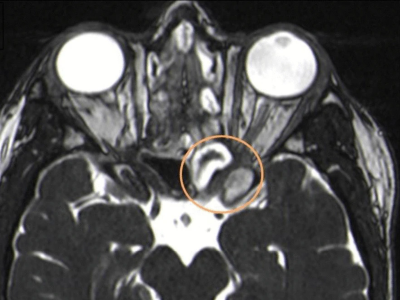 Optic Neuritis | Toxic retrobulbar neuritis due to recurrent ...