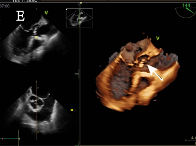 Endocarditis | Occult deterioration of an aortic annular abscess: how ...
