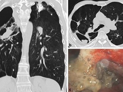 Aspergillus-Mykosen | Antiinfektive Therapie von Pilzinfektionen durch ...