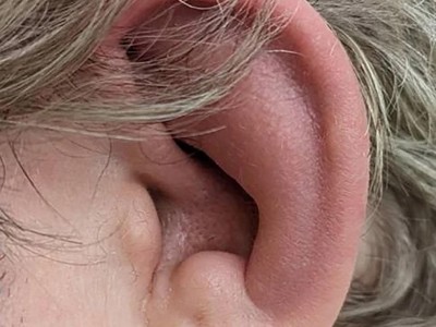 Ohrmuschel-Perichondritis | Relapsing Polychondritis | springermedizin.de