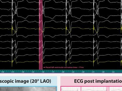 Atrioventricular Block | Loss of capture of conduction system pacemaker ...