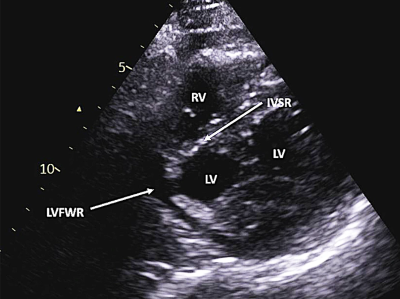 Myocardial Infarction | Up against the wall - emergency double ...