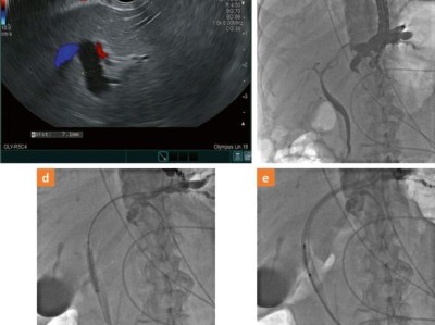 Operationen an Gallenblase und Gallenwegen | Endoskopische Therapieoptionen bei erschwertem ...