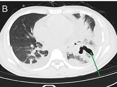 Lung Abscess | The first case report: diagnosis and management of ...
