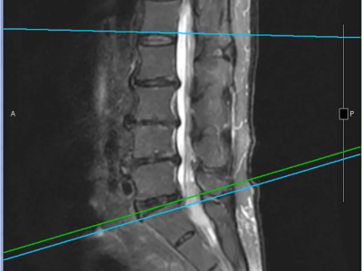 Colorectal Cancer | Sciatica caused by spinal epidural abscess as the ...