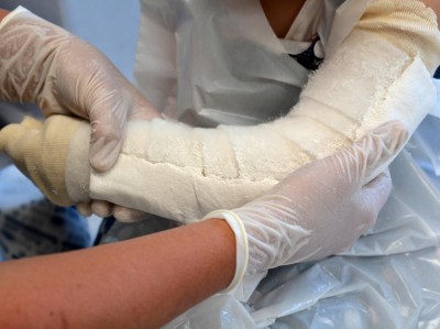 Osteosynthese | Frakturen der lateralen Tibiavorderkante ...