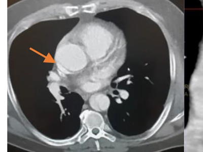 Aortic Dissection | Circumferent dissection of the ascending aorta ...