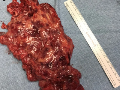 Pediatric Gynecology | Decidual cast: a rare cause of genital tract ...