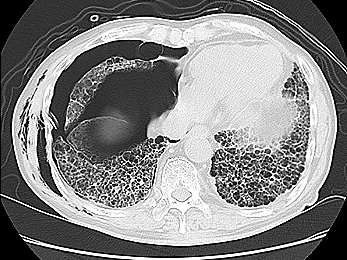 Pneumothorax | Combination of transbronchoscopic oxygen insufflation ...