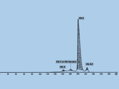 Abnormal glycated hemoglobin level in a patient with diabetes ...