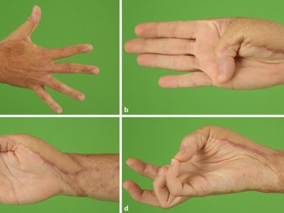 Verletzungen der Hand | Freie Medial-Sural-Artery-Perforator(MSAP ...