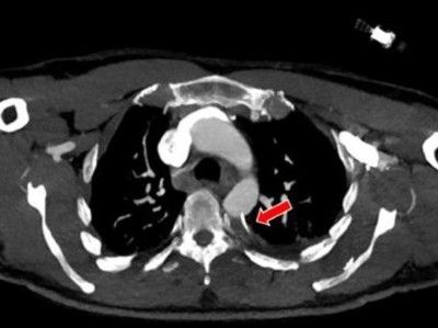 Stumpfes Thoraxtrauma | Stumpfes Thoraxtrauma mit traumatischer Aortenverletzung durch ...