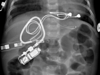 Pediatric Cardiology | Recent Advancements in Cardiac Implantable ...