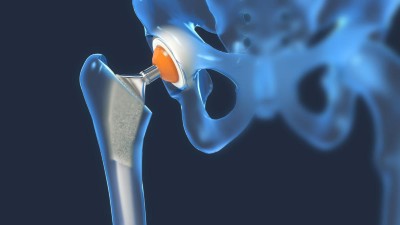 Total hip replacement beats resistance training for pain relief in severe hip osteoarthritis ...