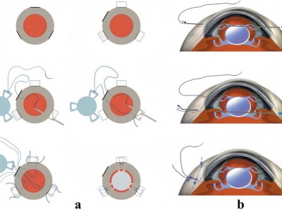 Lens Diseases | Recent advances and current challenges in suture and ...