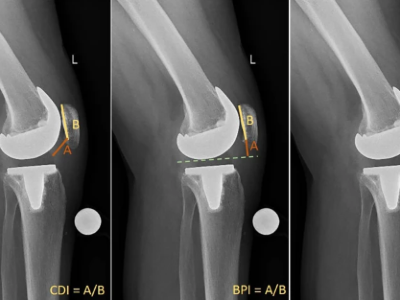 Patella baja | Chirurgische Optionen zur Behandlung einer Patella baja ...
