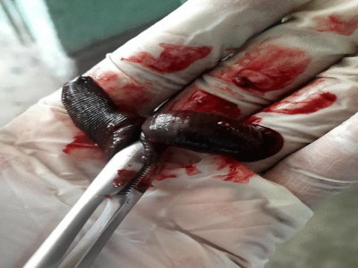 Anemia | Oropharyngeal leech infestation as a cause of severe anemia in ...
