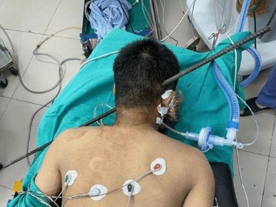 Traumatic Brain Injuries | Iron rod-induced perforating head injury of ...