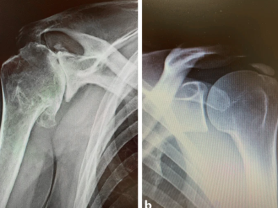 Schultersteife | Frozen Shoulder | springermedizin.de