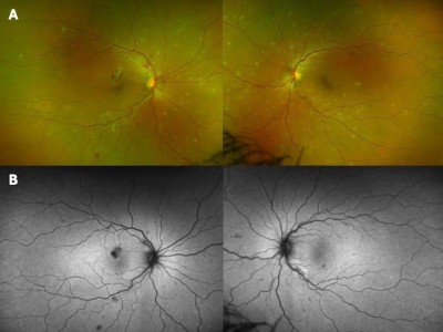 Retinal Diseases | Bilateral acute multifocal retinitis and retinal ...