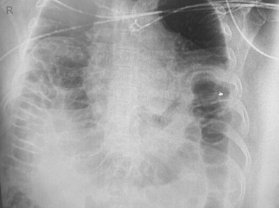 Diaphragmatic Hernia | Severe intestinal distension following HFNC ...